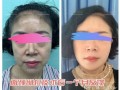 拉皮除皱能维持多久_拉皮除皱术后多久恢复自然