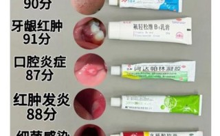 口腔溃疡吃什么药好使_口腔溃疡多久能好