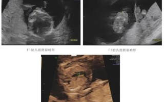 怀孕孩子畸形的征兆_孕期B超异常有哪些表现