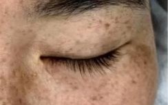 牛奶咖啡斑是什么_牛奶咖啡斑会遗传吗