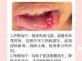 口腔溃疡怎么快速好_治口腔溃疡的偏方有哪些
