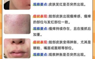 皮肤过敏症状图片_怎么判断是不是过敏