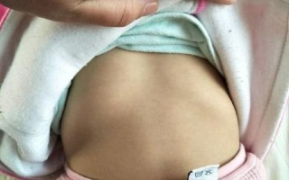 儿童鸡胸的症状有哪些_鸡胸图片怎么看