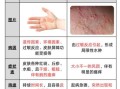 过敏症状图片怎么看_如何快速识别