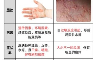 过敏症状图片怎么看_如何快速识别