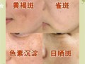 黄褐斑怎么淡化_黄褐斑图片怎么看