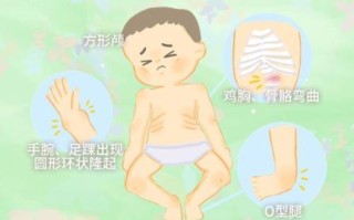 佝偻病的早期症状有哪些_如何判断佝偻病初期表现