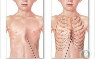 佝偻病早期症状图片_佝偻病能治好吗