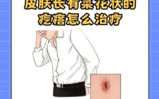 菜花状疙瘩是什么_会传染吗