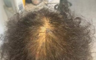 头顶头发稀少是什么原因_头顶脱发还能恢复吗