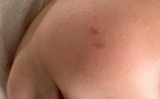 牛奶咖啡斑怎么治疗_会自己消失吗