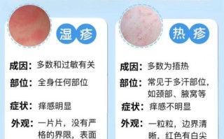 血热的症状有哪些_湿疹反复发作怎么办