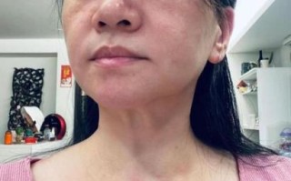 海鲜过敏是什么原因_海鲜过敏症状有哪些