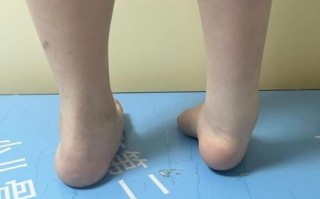 马蹄足内翻矫正后遗症有哪些_如何避免二次手术