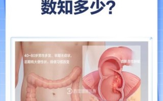 肠癌早期一天几次大便_肠癌早期排便次数变化