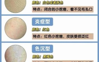 鸡皮肤怎么消除最有效_手臂鸡皮肤怎么改善