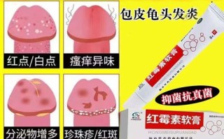 红霉素软膏可以擦龟头吗_龟头炎能用红霉素软膏吗