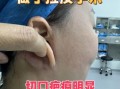 小拉皮手术害了我_小拉皮手术失败怎么办