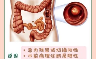 结肠息肉会癌变吗_结肠息肉切除后复发吗