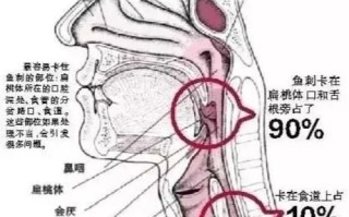 鱼翅卡喉咙怎么办_如何快速取出