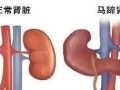 马蹄肾是怎么回事_马蹄肾会影响寿命吗