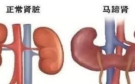 马蹄肾是怎么回事_马蹄肾会影响寿命吗