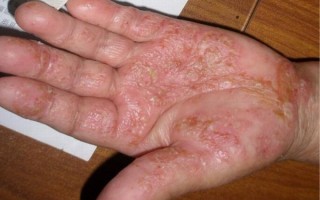 鹅掌癣初期症状图片_鹅掌癣会传染吗