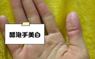 鹅掌风用醋泡多久能好_醋泡鹅掌风正确方法