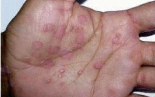 男性菜花病初期症状图片_菜花病长什么样