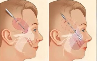 拉皮是怎么做出来的_拉皮手术全过程揭秘