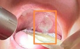 口腔溃疡中间白色是啥东西_溃疡白膜多久脱落