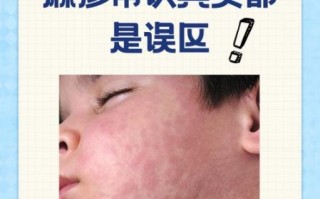 荨麻疹是因为太脏吗_荨麻疹和卫生差有关吗