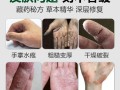 鹅掌风用什么药_鹅掌风最佳外用药