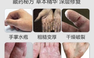 鹅掌风用什么药_鹅掌风最佳外用药