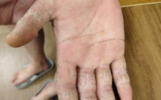 鹅掌风图片症状_鹅掌风初期长什么样