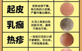 湿疹最怕的三个土办法_真的有用吗