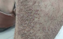 淀粉样变是什么病_淀粉样变能活多久