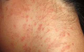 蔓越莓过敏症状有哪些_蔓越莓过敏图片怎么看