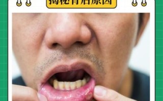 口腔溃疡白色假膜能不能刮掉_棉签刮除后多久能好