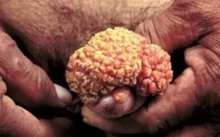 男性菜花状疣高清图片_早期症状有哪些