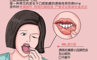 口腔溃疡怎么办最快_口腔溃疡怎么快速止痛