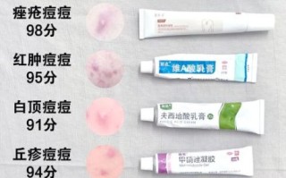 祛痘药膏哪个好_祛痘药膏排行榜10强