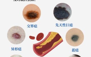 色素痣会癌变吗_色素痣去除方法