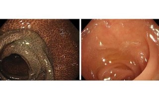 酵素吃出黑肠子_黑肠子真相