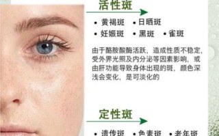 黑色素克星是什么_如何有效淡化色斑