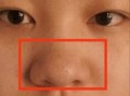 大蒜鼻整容效果图_真实案例