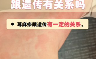 荨麻疹是肝癌的前兆吗_荨麻疹和肝癌的关系 荨麻疹是肝癌的前兆吗_荨麻疹和肝癌的关系