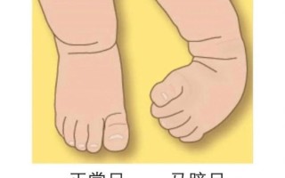 马蹄足是怎么引起的_马蹄足形成原因