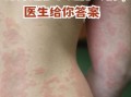 身上起红疹子很痒怎么办_常见疹子症状图片对照