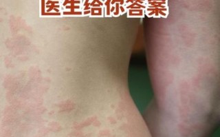 身上起红疹子很痒怎么办_常见疹子症状图片对照